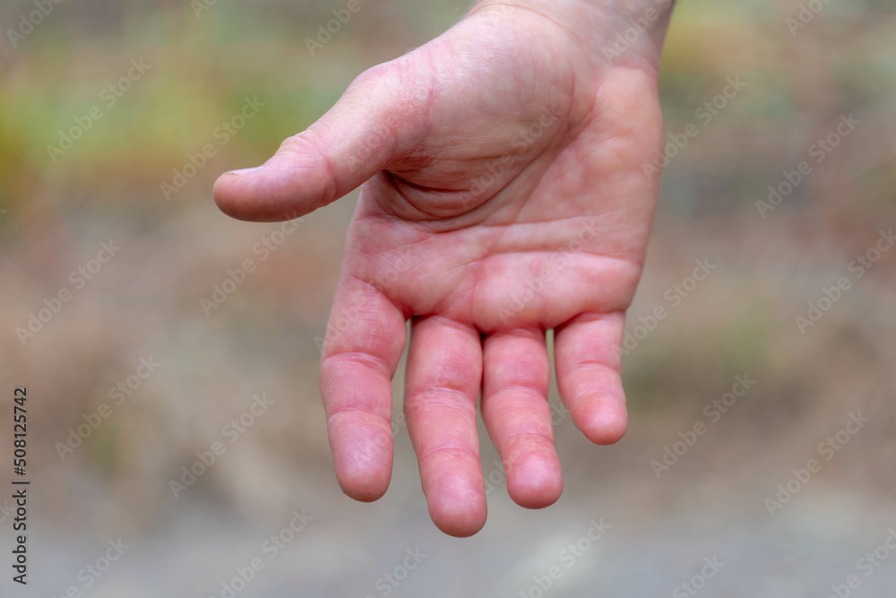 Healthcare and medical concept, Selective focus of little bit swollen ...