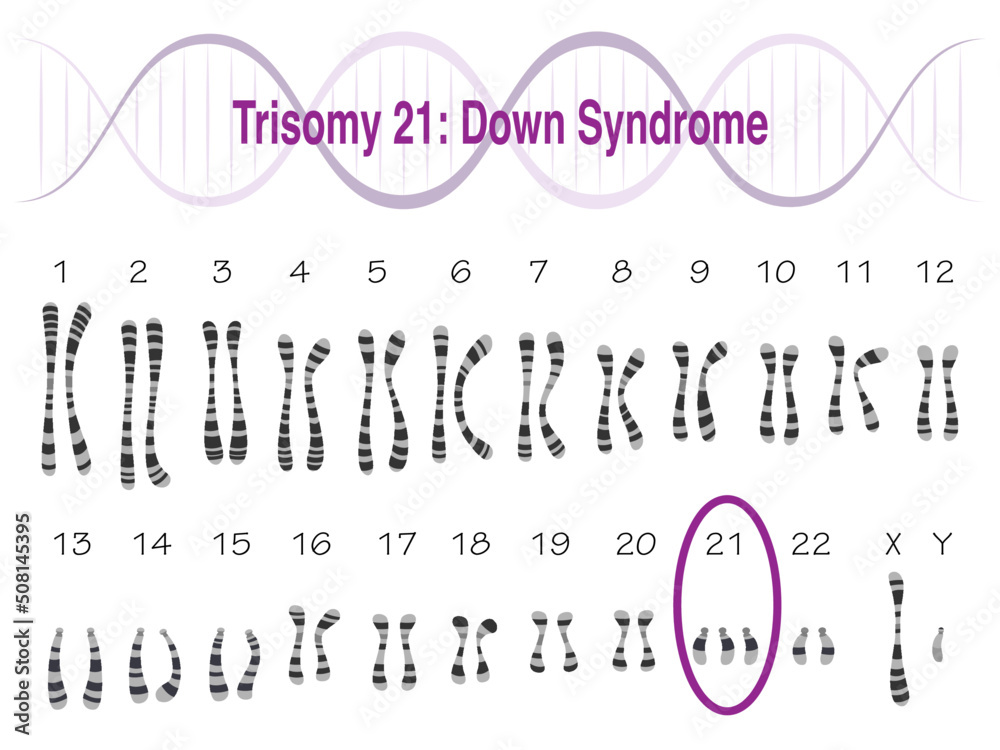 Trisomy 21 Down Syndrome Karyotype Stock Vector | Adobe Stock
