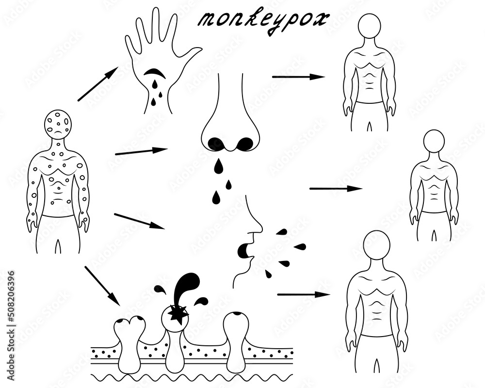 Methods of human infection with monkeypox. Diagram of human-to-human ...