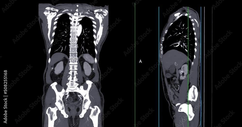 CT SCAN of Chest and Abdomen with injection contrast media for ...
