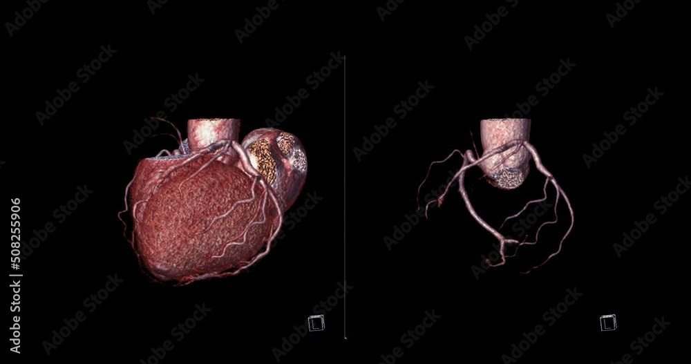 CTA Coronary artery 3D rendering image and coronary tree turn around on ...