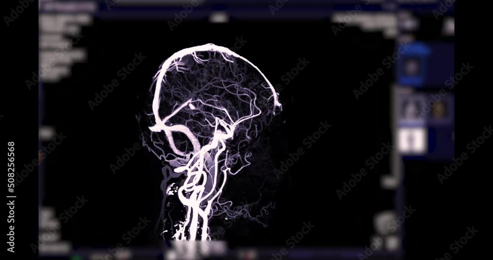 Vidéo Stock CTV Brain scan 3D rendering for diagnosis venous sinus ...