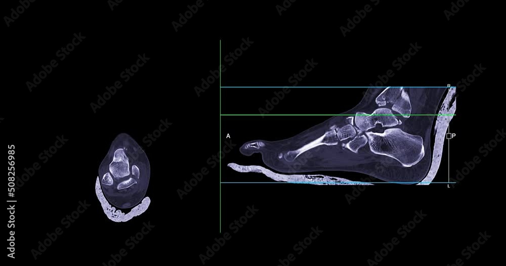 CT Scan of foot for diagnosis bone fracture. Stock Video | Adobe Stock