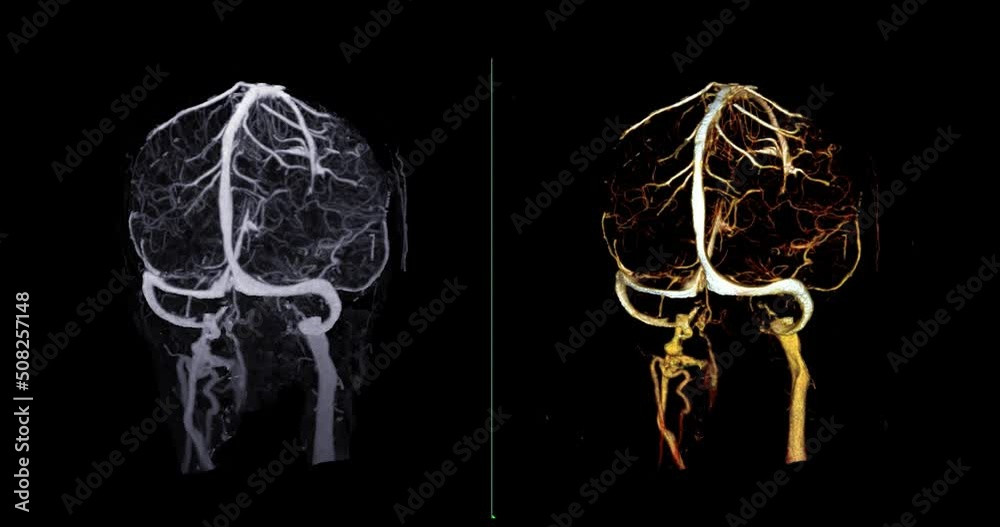 Vidéo Stock CTV Brain scan 3D rendering for diagnosis venous sinus ...
