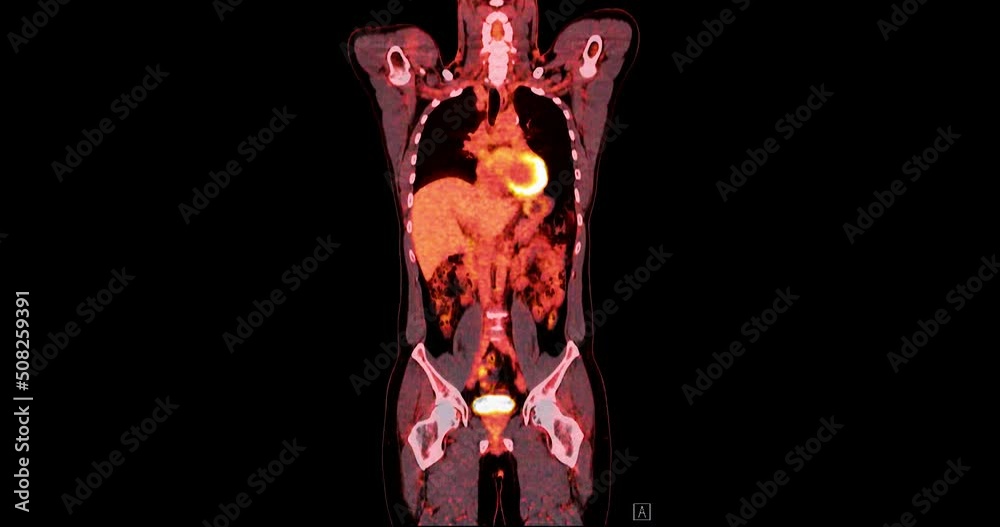 PET CT ( Positron Emission Tomography ) of whole human body 3d ...