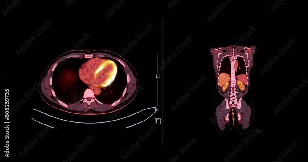 PET CT ( Positron Emission Tomography ) of whole human body 3d ...