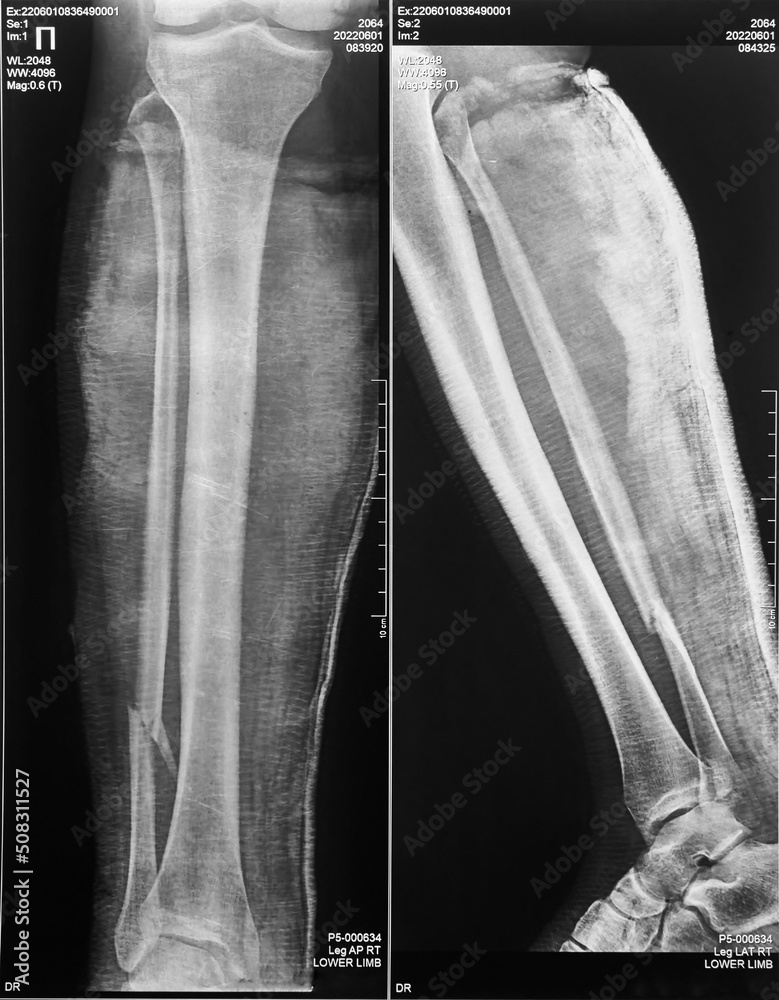 Radiograph of a comminuted fracture of the lower leg with displacement ...