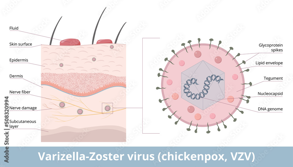 Varicella Zoster Virus Chickenpox Vzv Detailed Scheme Of Varizella