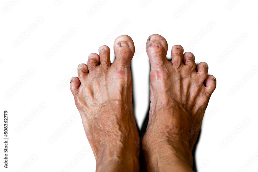 Foto de Old people's feet with fungal nails. foot screening test ...