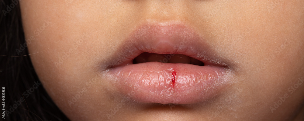 Girl lips with crack and blood Stock Photo | Adobe Stock