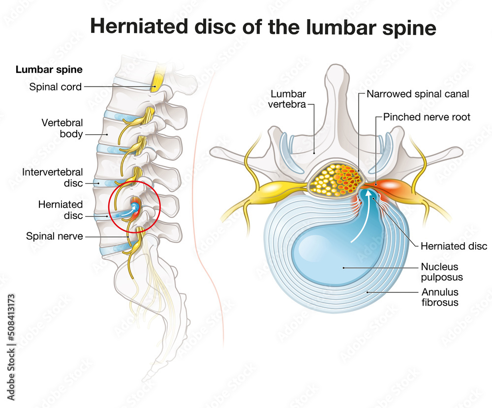 Herniated disc of the lumbar spine, stenosis, slipped disc. Medical ...
