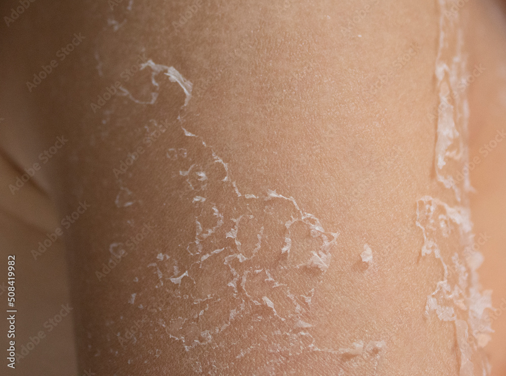 Texture of irritated skin with cracks of dead cells and redness after ...
