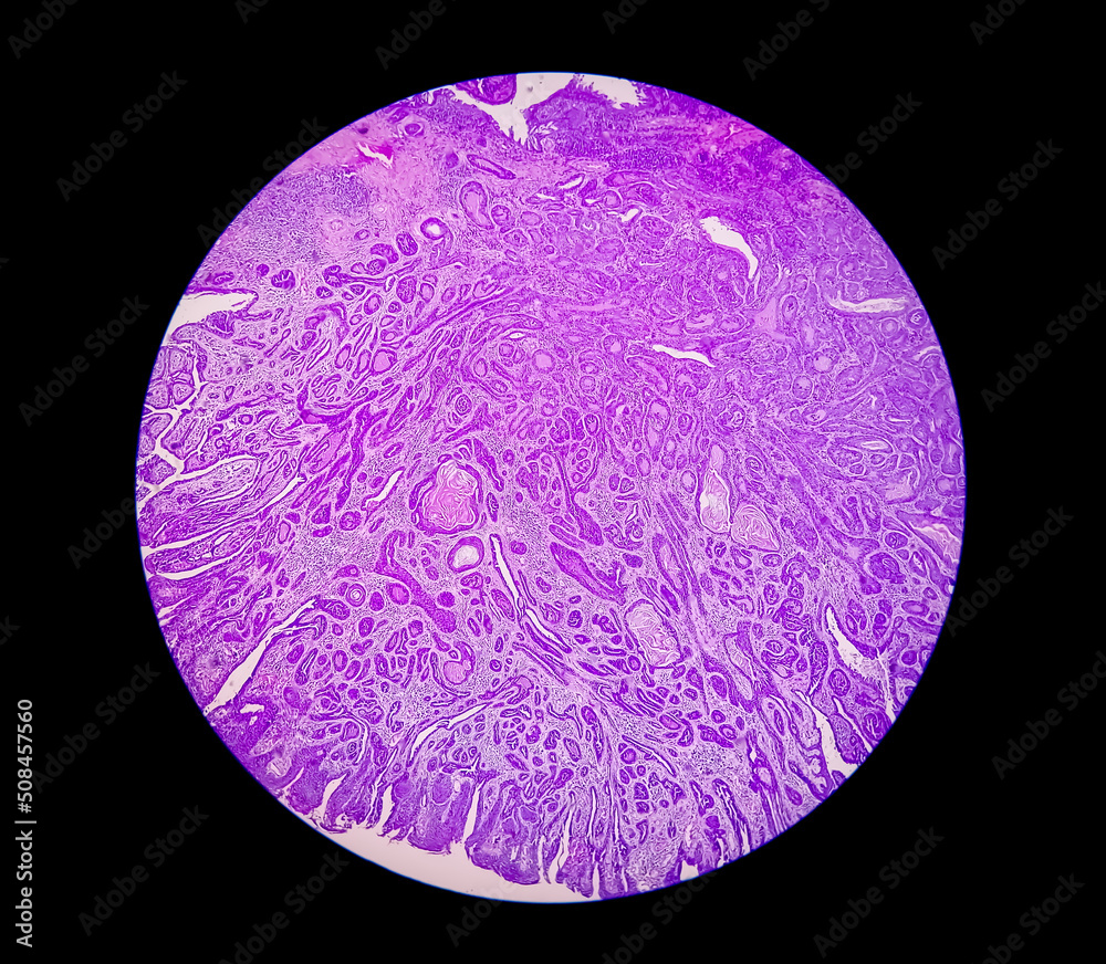 Poster Histological slide under microscopy showing Pedunculated ...