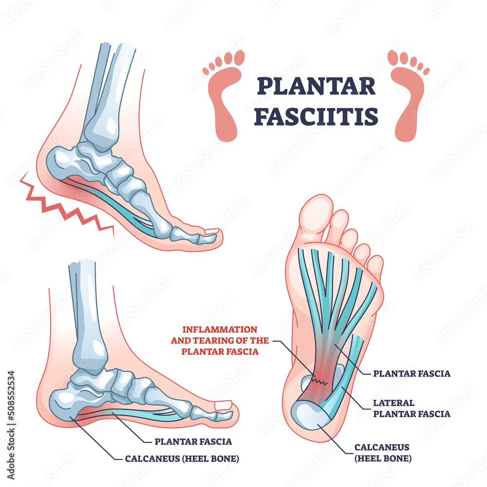 Plantar fasciitis as fascia muscle inflammation and tearing outline ...