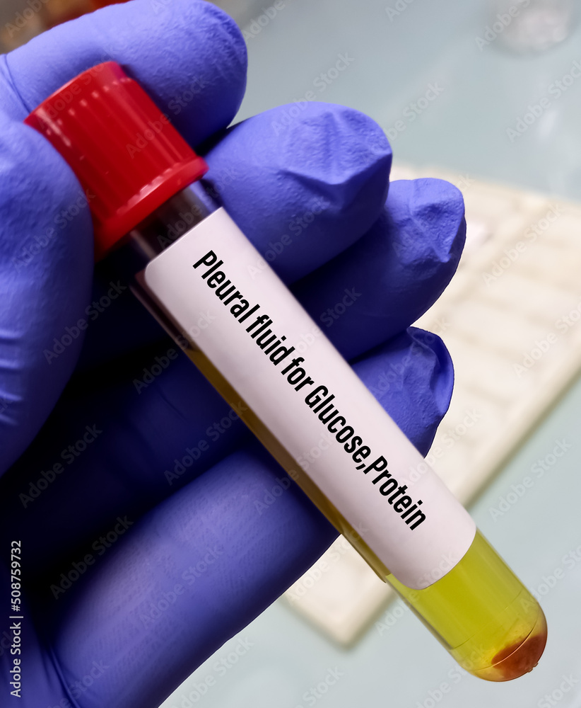 Pleural fluid sample for biochemical test (Glucose, Protein). Pleural ...