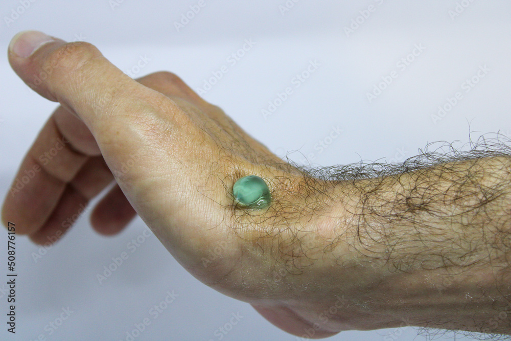 Deep freeze pain relief gel on anatomical snuffbox for a sprained wrist ...