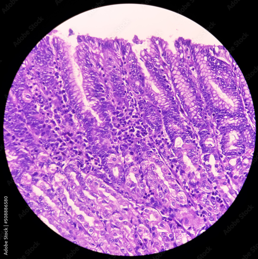 Resected lower part of stomach(biopsy): Lymph node show reactive change ...