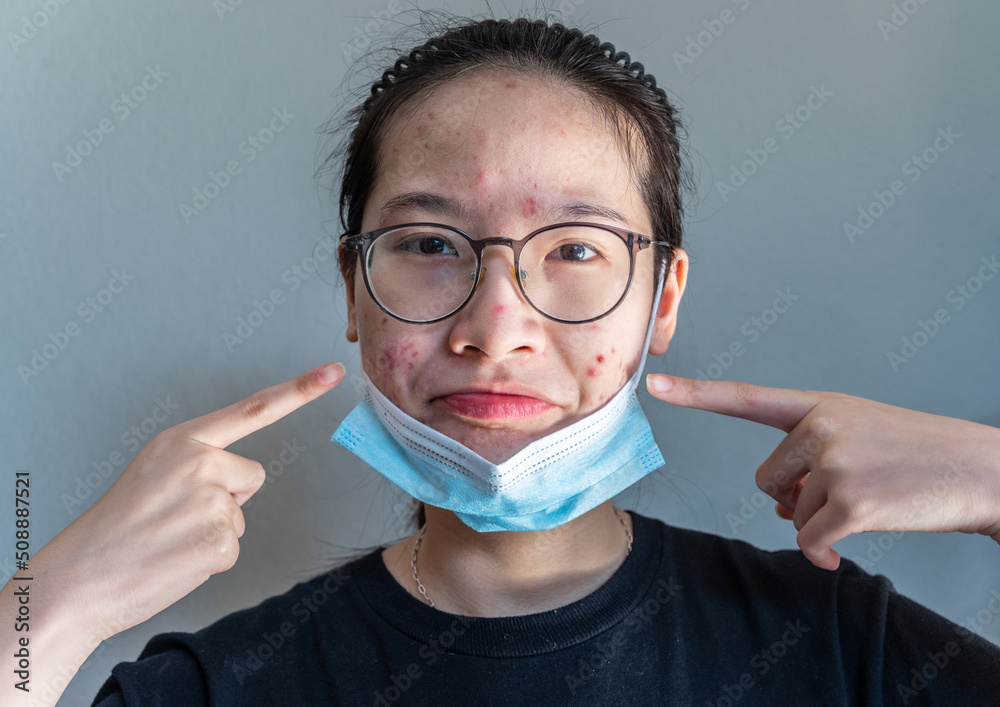 Young Asian woman open her mask and pointing acne problem occur on her ...