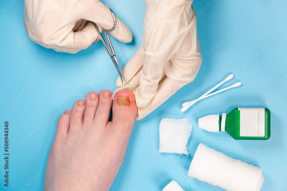 doctor cuts the injured toenail. Hands in rubber gloves touch injured ...