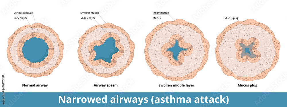 Stages of airways narrowing during asthma attack with possible ...