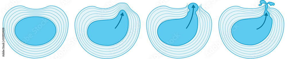 Herniated disc schema. Normal disc. Bulge. Protrusion. Extrusion ...