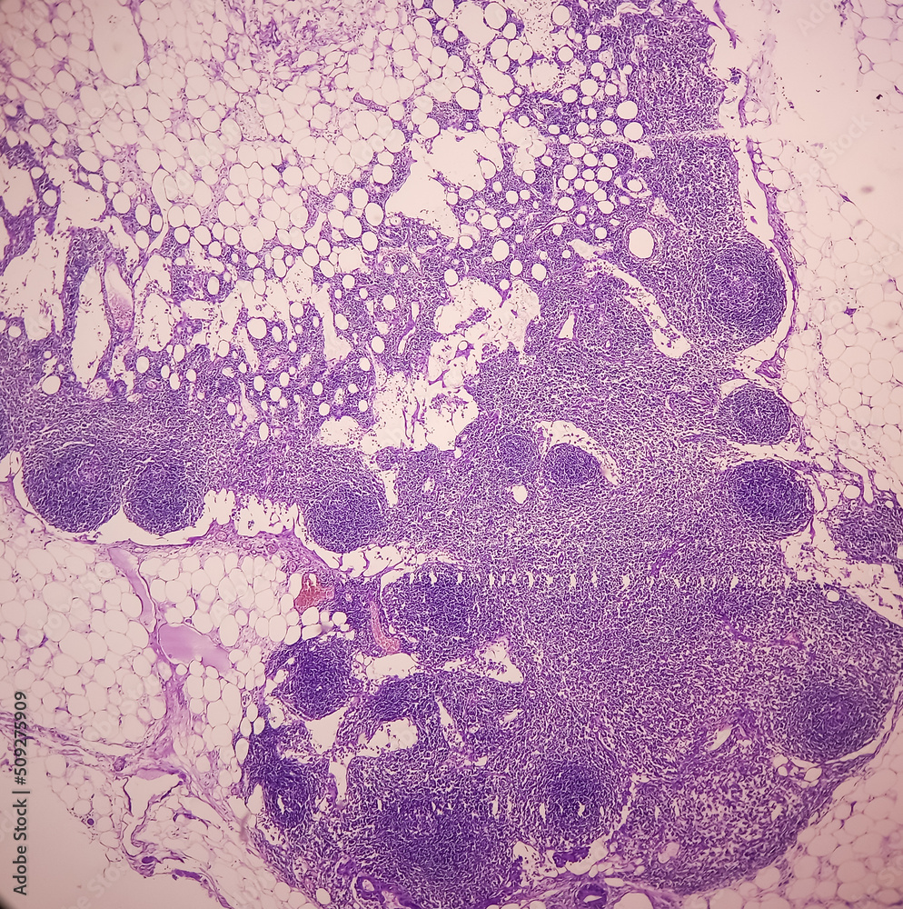 Resected lower part of stomach(biopsy): Lymph node show metastatic ...