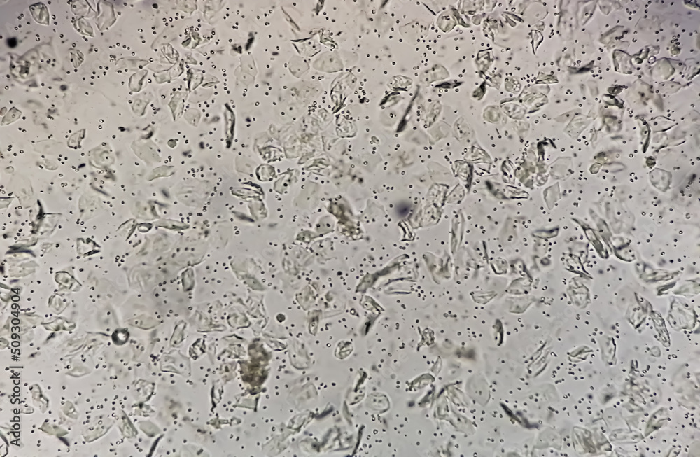 Microscopic urine examination showing Hyaline cast with plenty pus cell ...