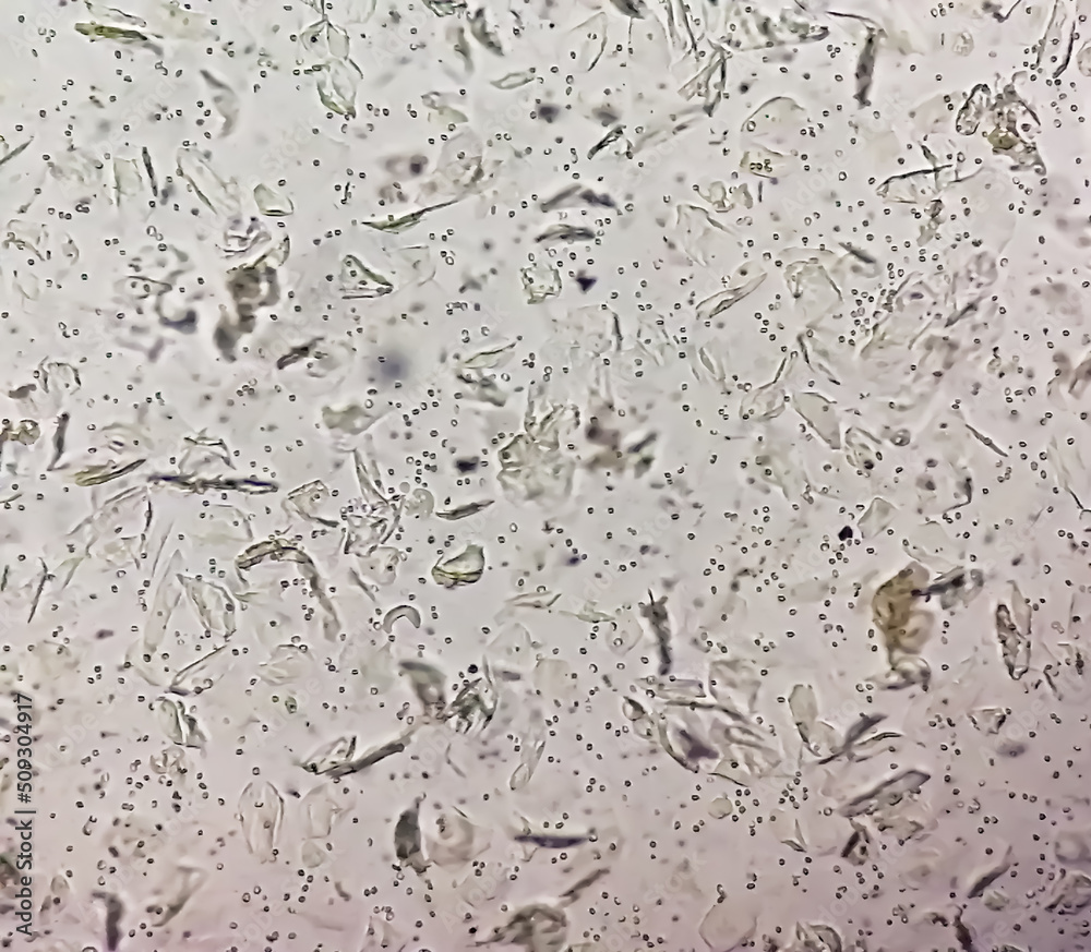 Microscopic urine examination showing Hyaline cast with plenty pus cell ...