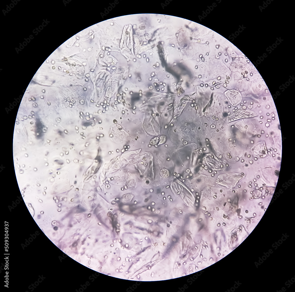 Microscopic urine examination showing Hyaline cast with plenty pus cell ...
