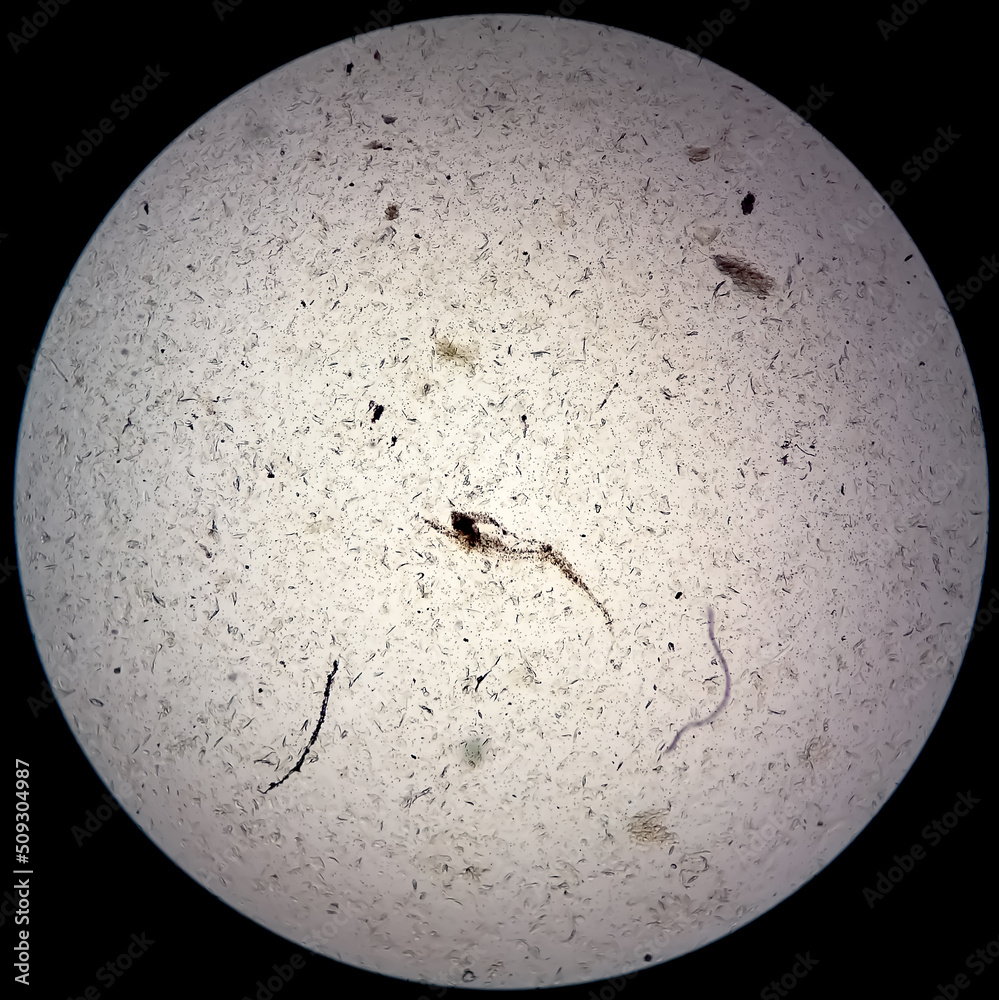 Microscopic urine examination showing Hyaline cast with plenty pus cell ...