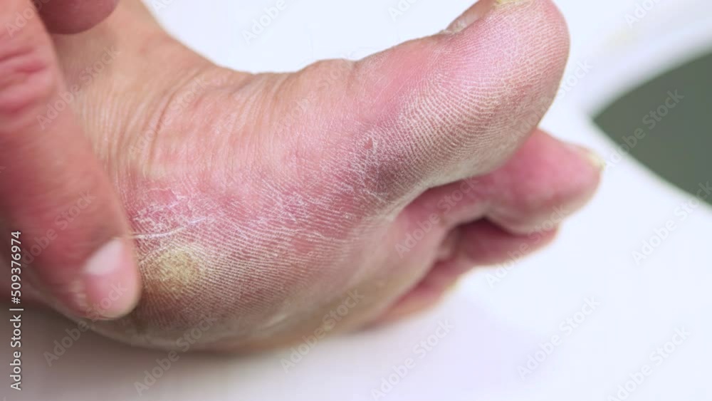 Big toe with keratinized skin. Keratinization and thickening of the ...
