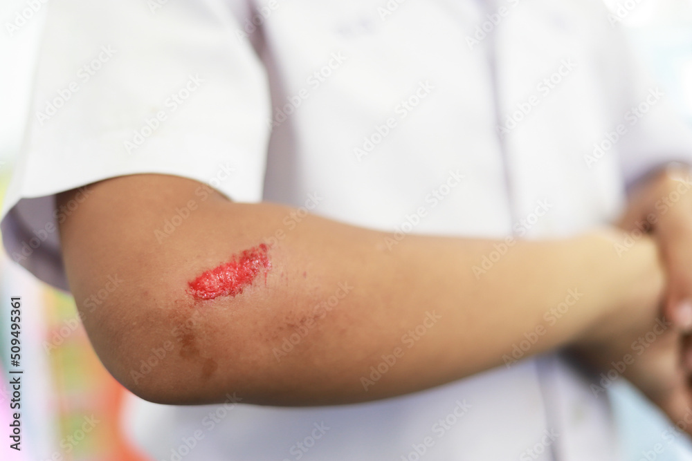 red bleeding wound on kid arm from hard playing in activity. selective ...