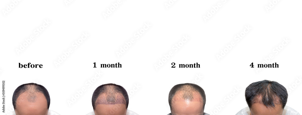 Hair transplantation surgery steps. Patient before and after the ...