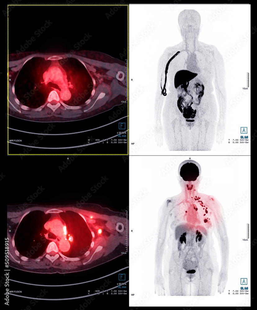 PET Scan image of whole human body. Stock Photo | Adobe Stock