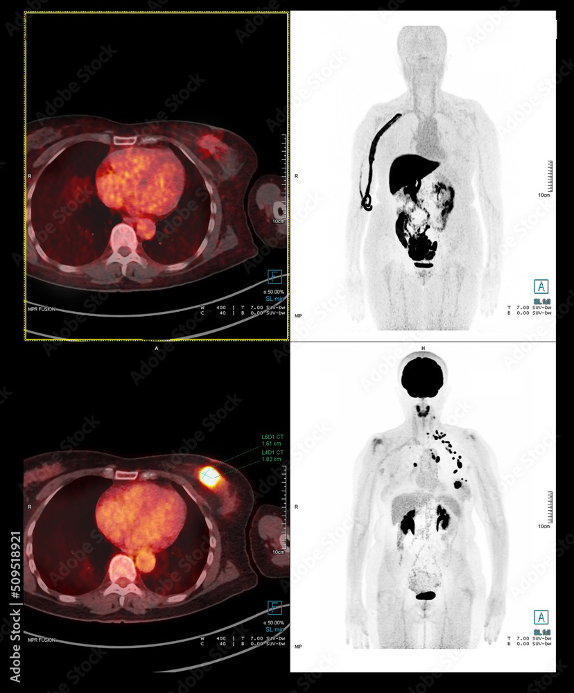 PET Scan image of whole human body. Stock Photo | Adobe Stock