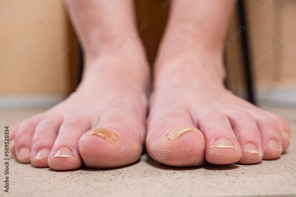 Feet of person infected with fungus on white tile floor. Toenails with ...