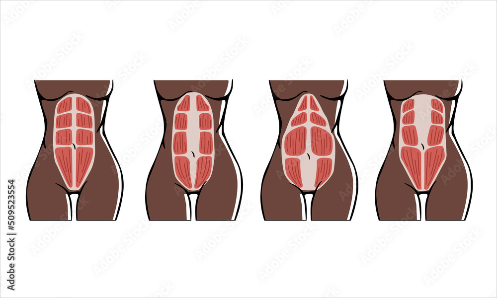 Vetor do Stock: Different types of Diastasis on non-Caucasian skin ...