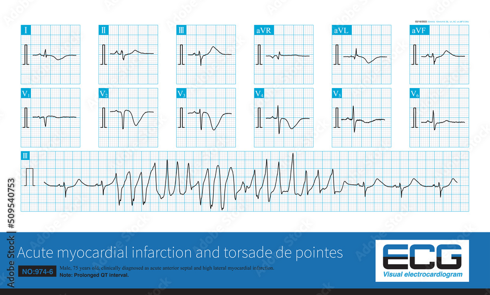 Male, 75 years old, clinically diagnosed as acute anterior septal and ...