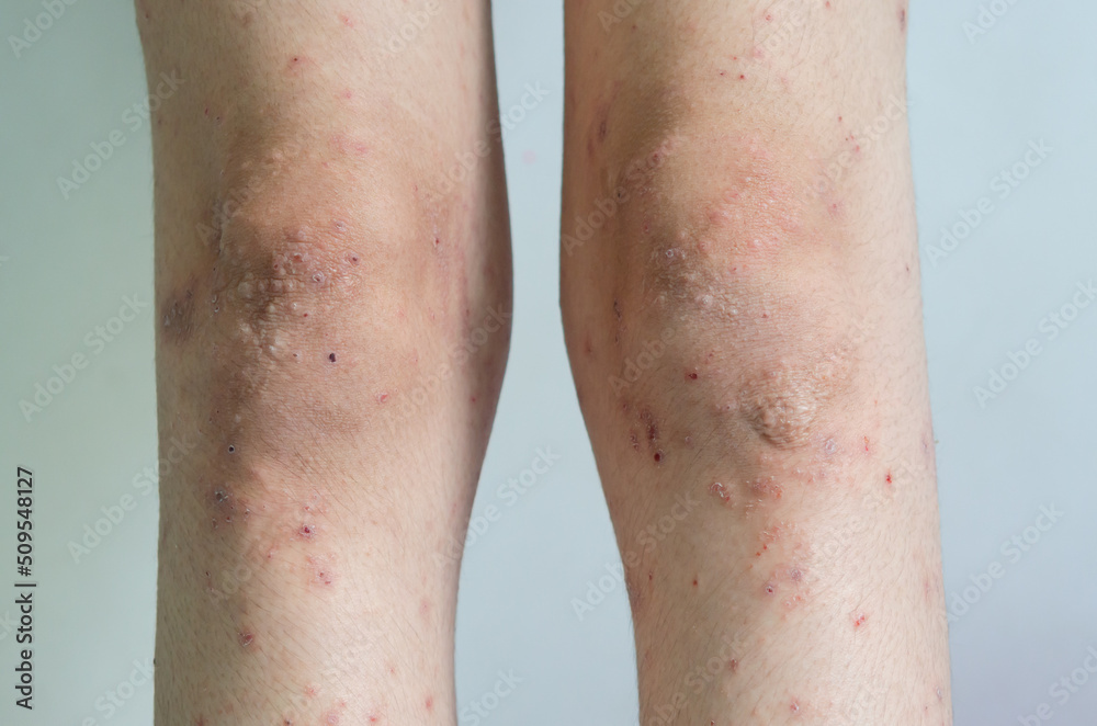 red rash girl Skin disease caused by allergies to drugs, food ...