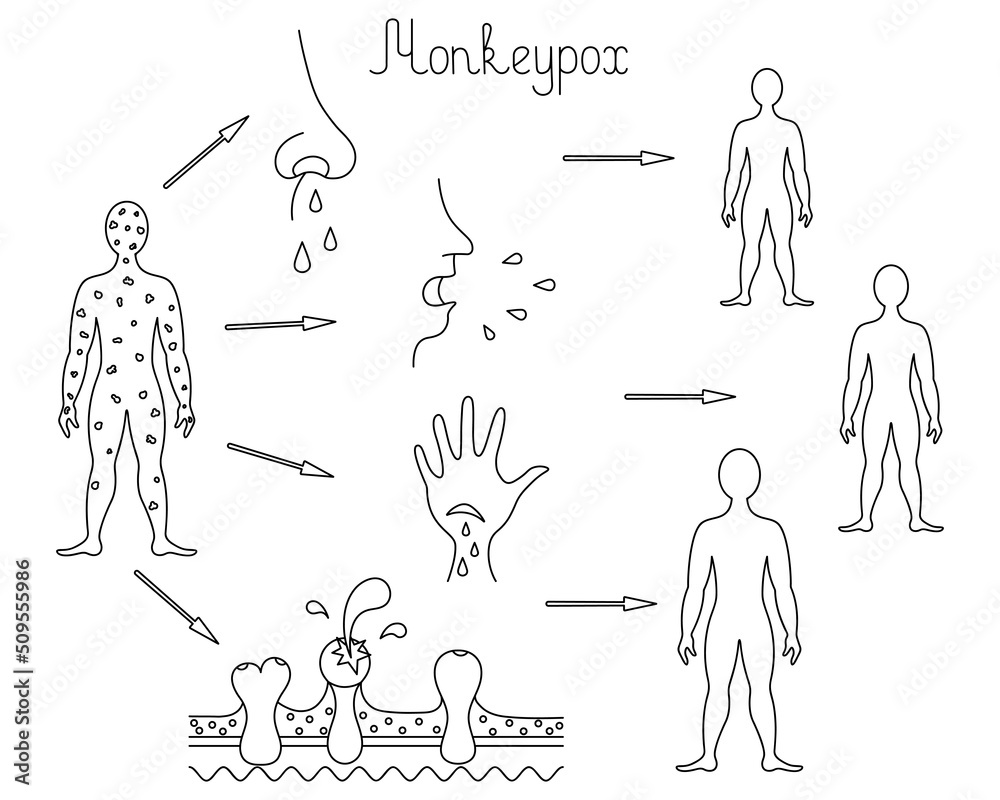 The mechanism of transmission of monkeypox. Diagram of human-to-human ...