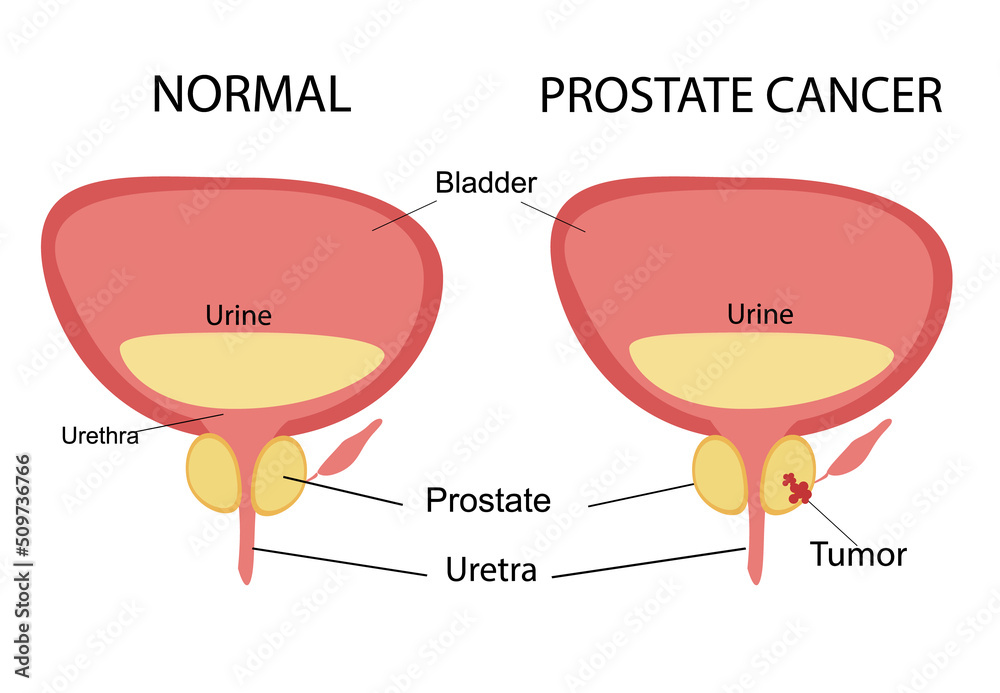 Healthy prostate and prostate cancer. Illustration of male reproductive ...