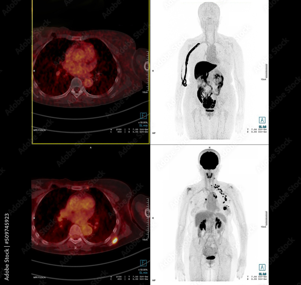 Poster PET Scan image of thorax or chest Comparison Axial , Coronal for ...
