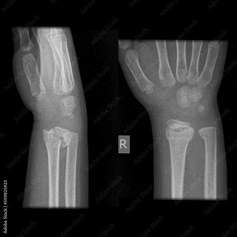 growth plate fracture on hand and leg x ray image Stock Photo | Adobe Stock