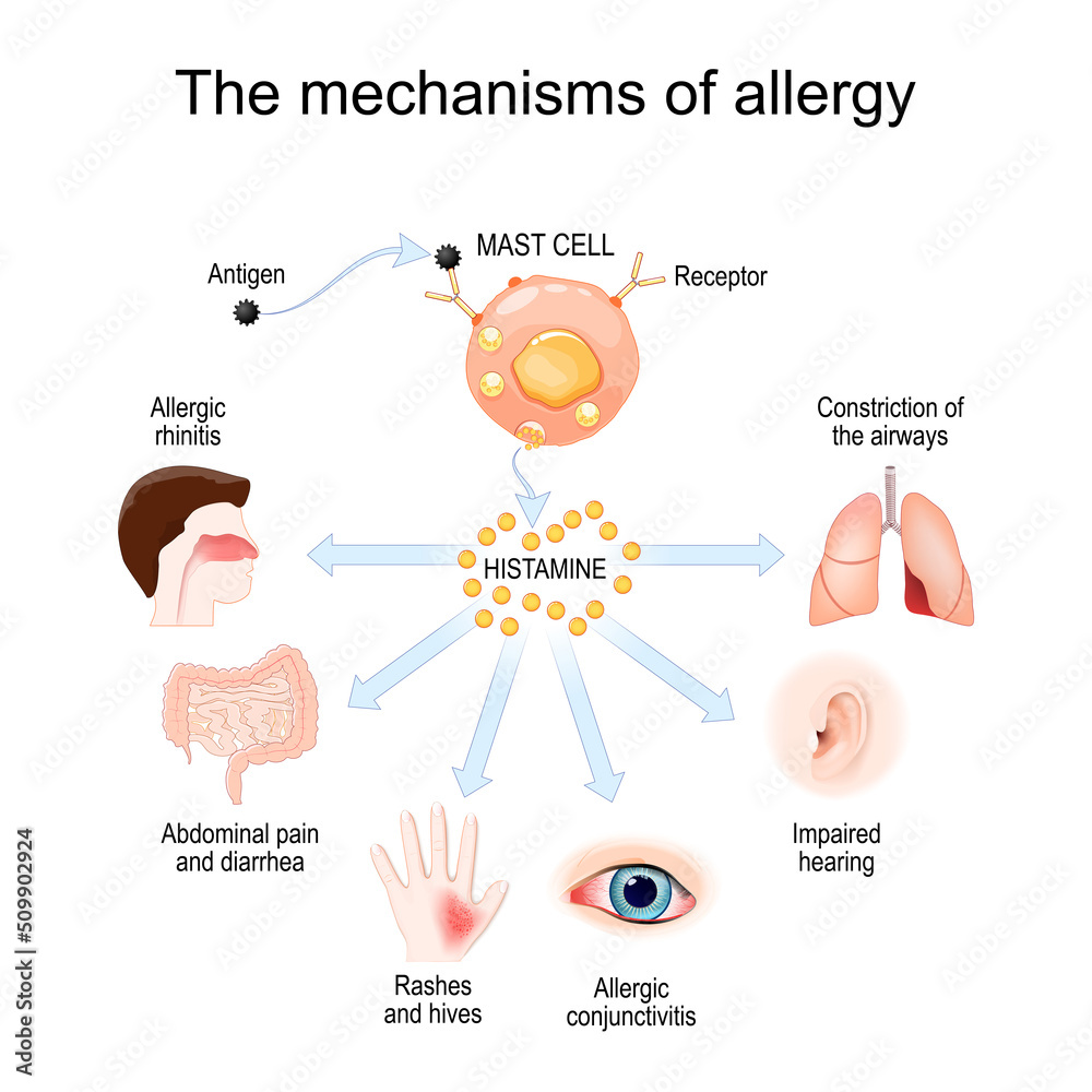 Naklejka Mechanism of allergy. Mast cells and allergic reaction ...