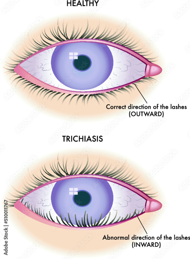 Medical illustration shows the comparison between a normal eye and one ...