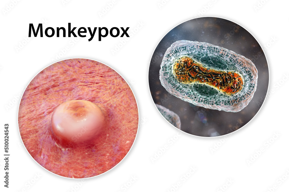 Skin lesions in monkeypox infection, 3D illustration Stock Illustration ...