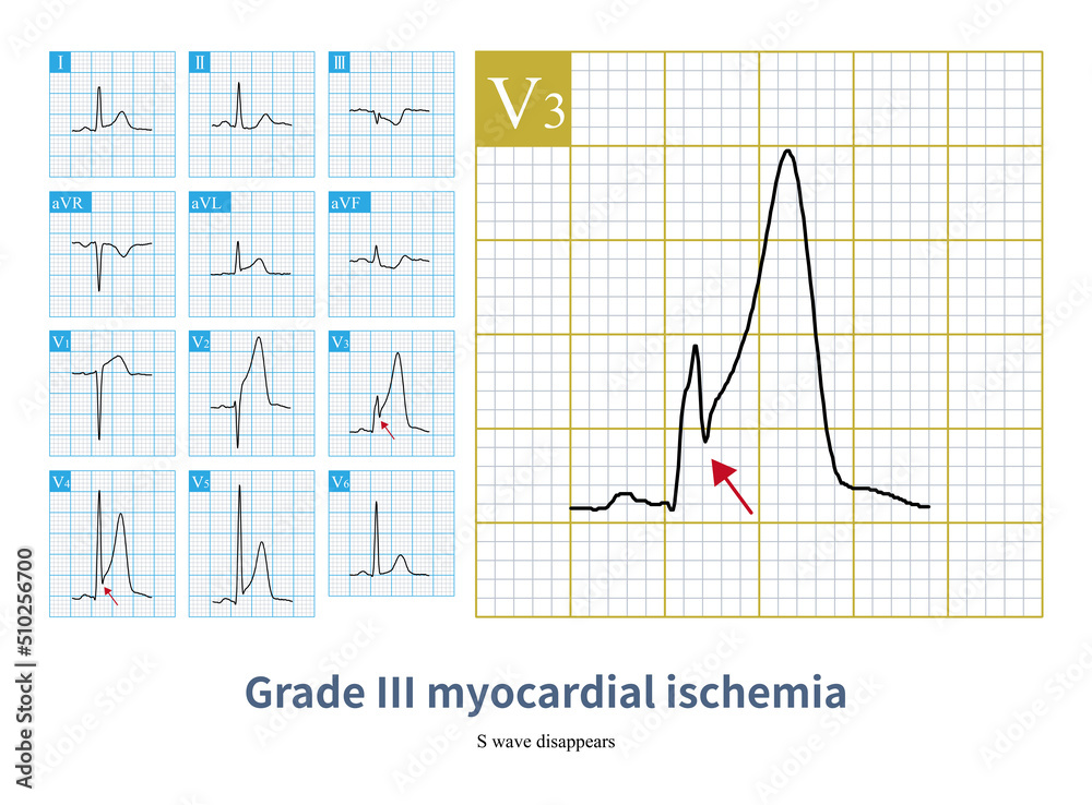 Male, 58 years old, admitted with chest pain for 30 minutes. ECG showed ...