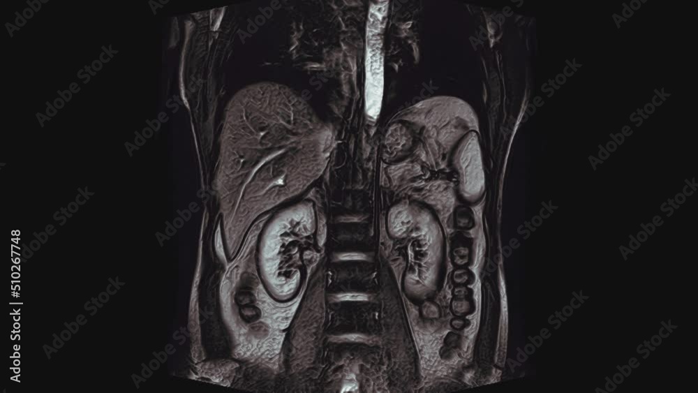 Voluminous color CT scan of the abdomen. Computed tomography of the ...