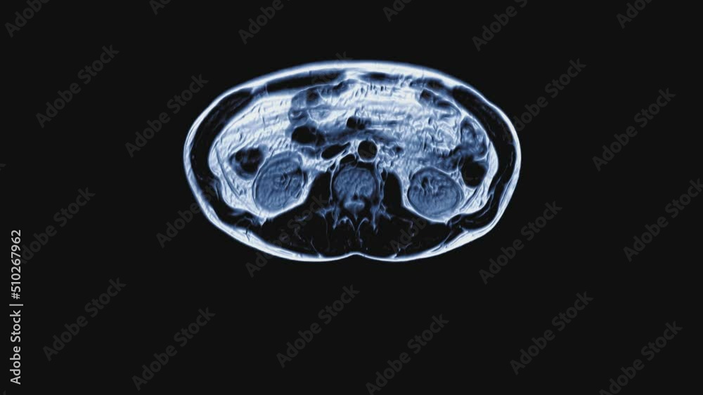 Voluminous color CT scan of the abdomen. Computed tomography of the ...