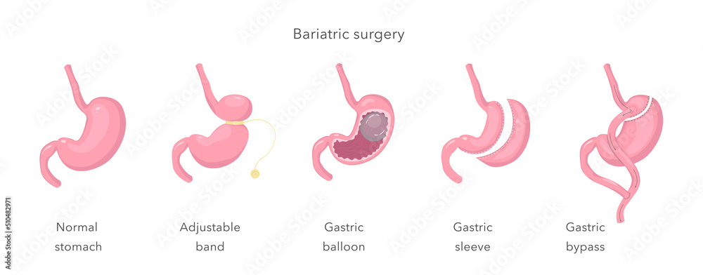 Methods of weight loss operation. Bariatric surgery. Human anatomy ...